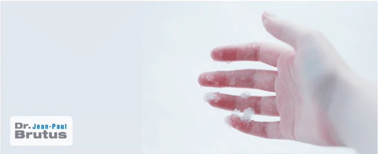 C'est l'hiver, attention aux engelures aux doigts | Dr Brutus